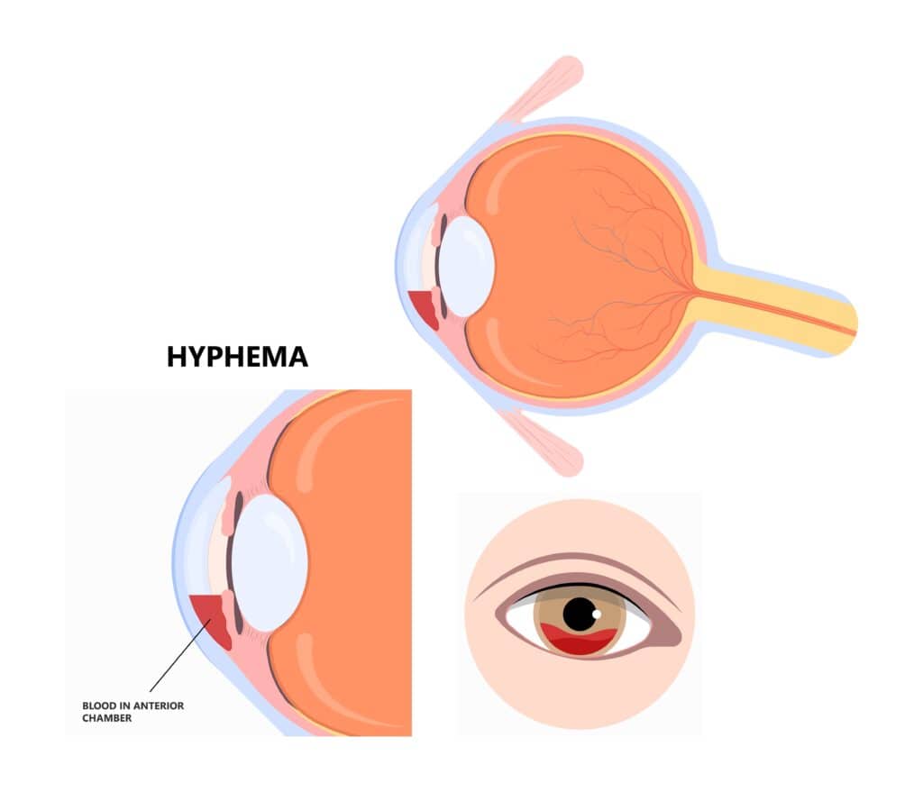 Hyphemas,Red,Eye,Bleeding,Injury,And,Cause,Pain,Symptoms,Sickle - Boxer ...