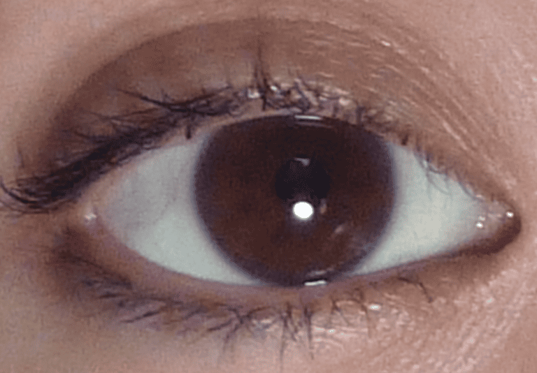 Pinguecula Removal Los Angeles - Yellow Spot Fix Beverly Hills