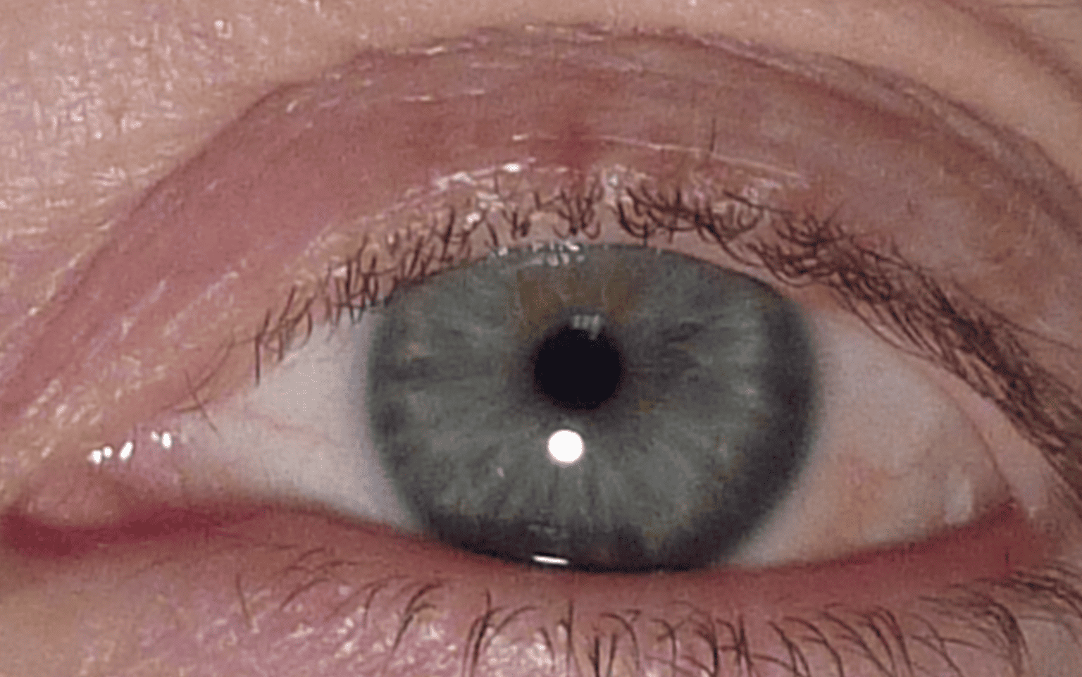 Pinguecula Removal Los Angeles - Yellow Spot Fix Beverly Hills